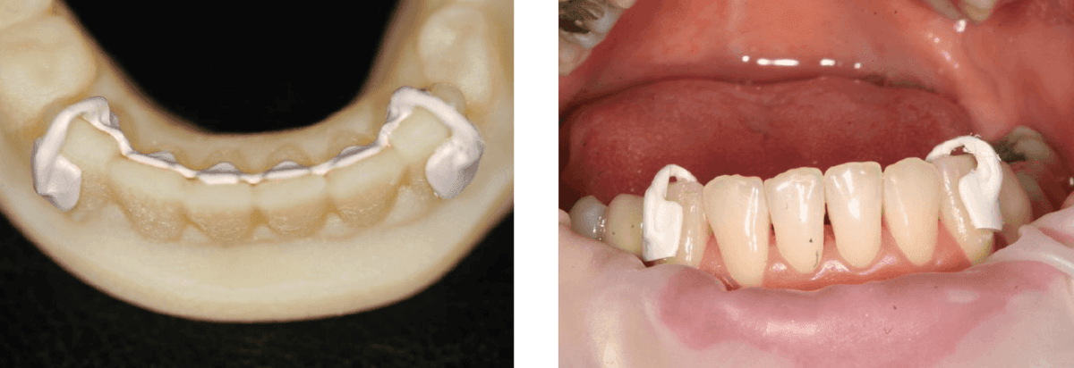 Fixed Orthodontic Retainer